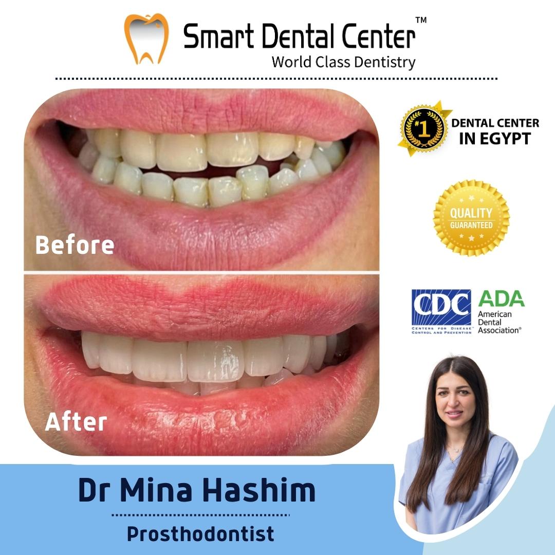cases - Smart Dental Center